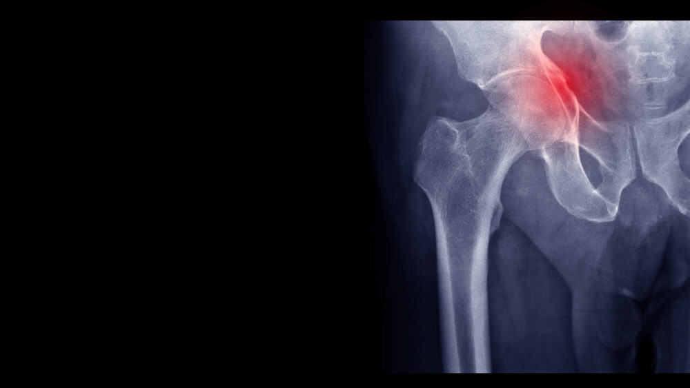 Fractured Bones in Car, Truck, and Motorcycle Accidents | Injury Lawyers